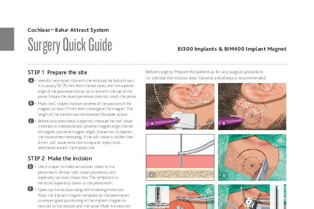 Baha® system surgical guides | Surgical resources | Cochlear