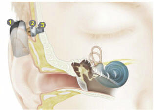 Baha System Product Specs & Guide | Baha External Processors